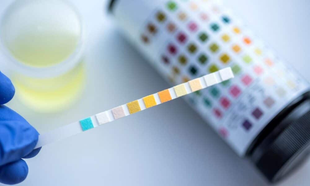 Bandelette urinaire : comment interpréter les résultats ? - Le ...